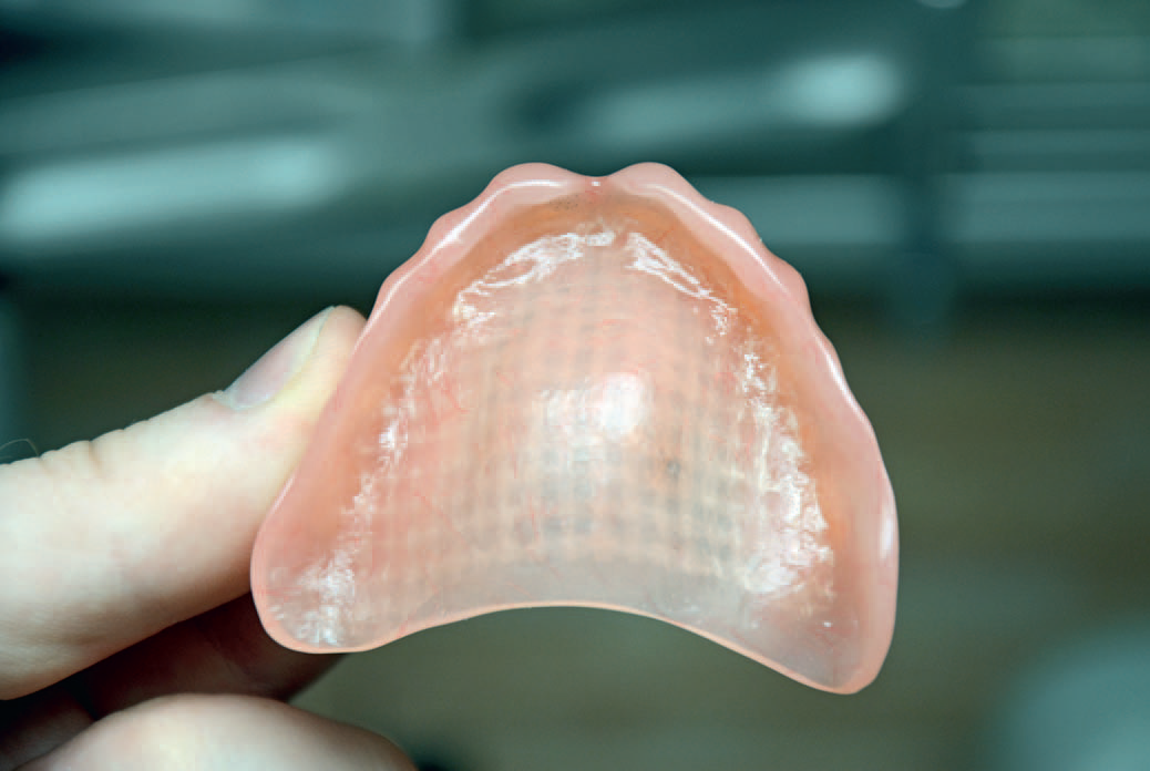 Fast Splint – czyli o tym, jak szybko i łatwo wykonać szynę wzmacniającą